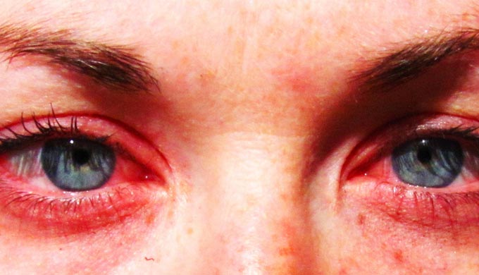 How to Combat the Annual Bout With Cedar Fever